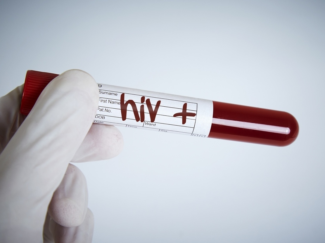HIV dispara e ultrapassa limite da OMS em 64%, em Porto Alegre - Brazil ...
